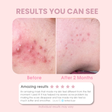 RIKI Baby Face | LED Therapy Skincare Wearable Facial Mask