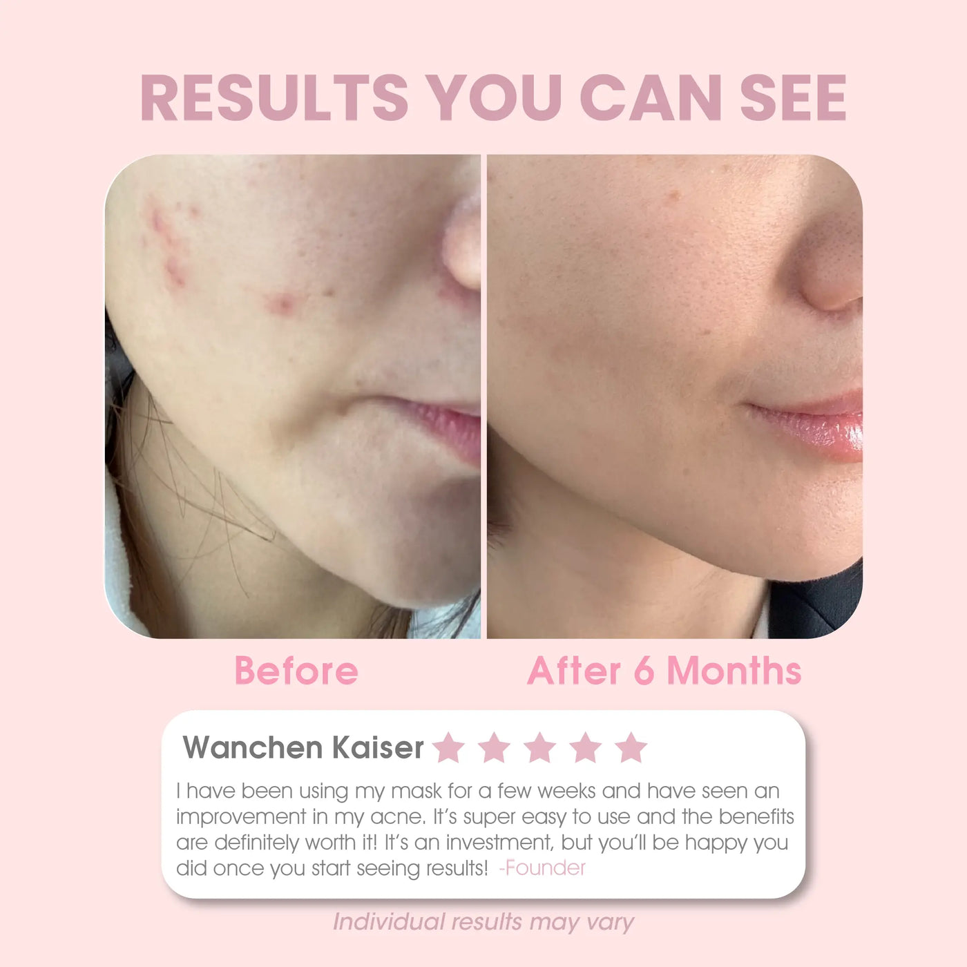RIKI BABY FACE | Best LED skincare therapy mask for wrinkles & acne